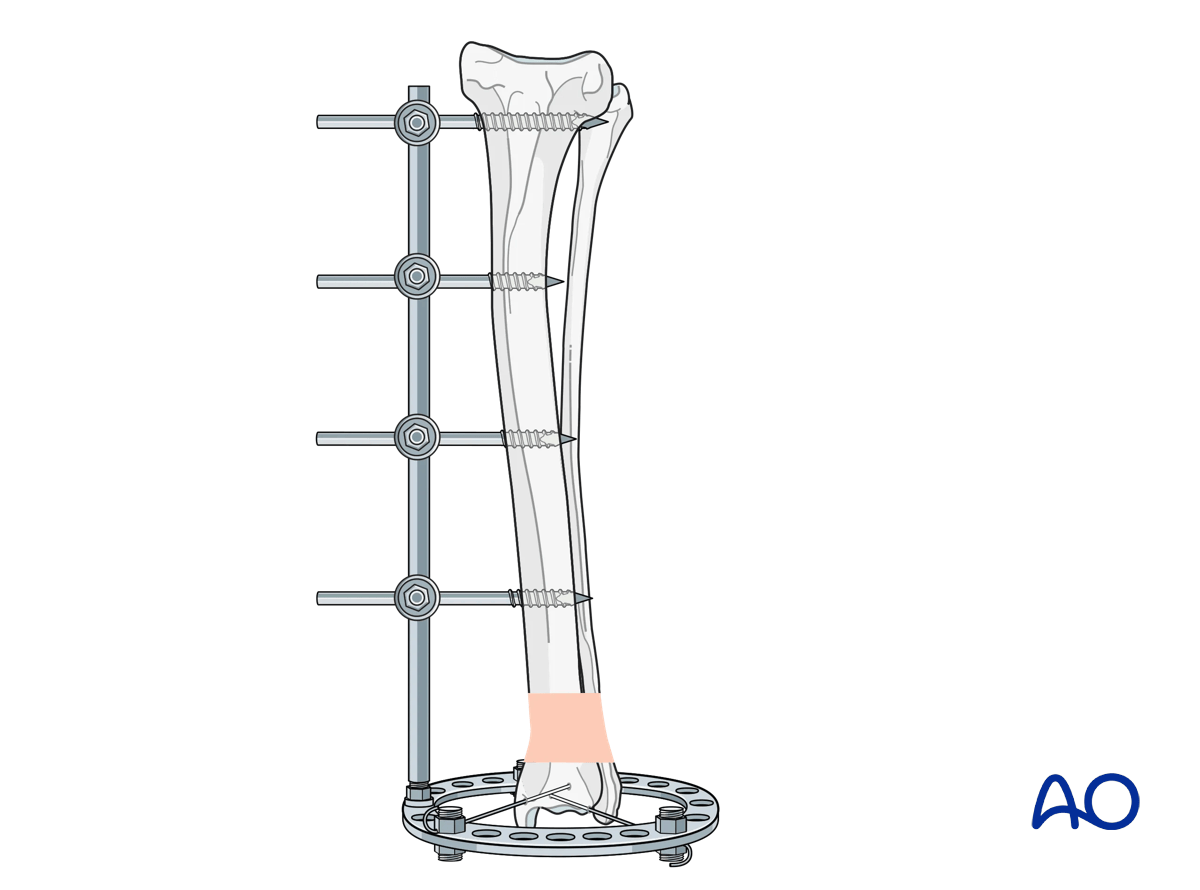 General considerations on external skeletal fixators