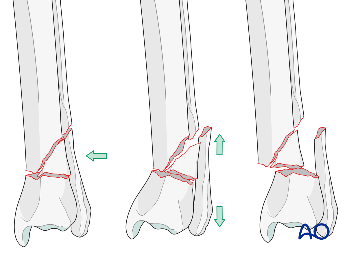 Neutralization plating (plate and lag screw) for Extraarticular wedge ...