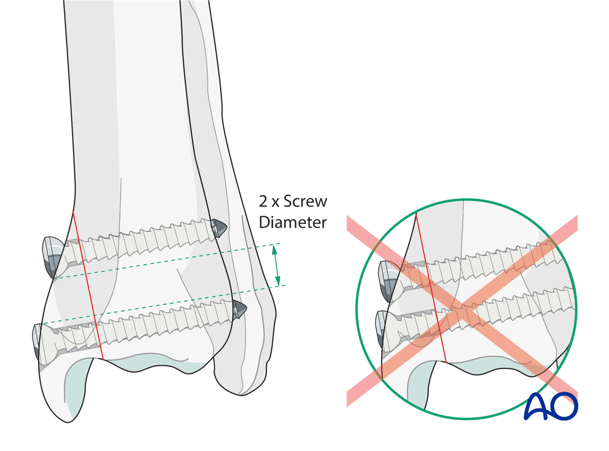 Lag screw fixation
