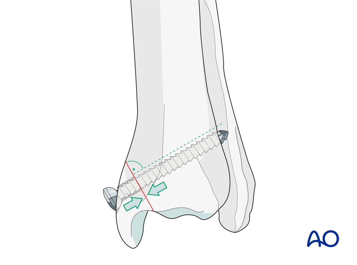 Lag screw fixation
