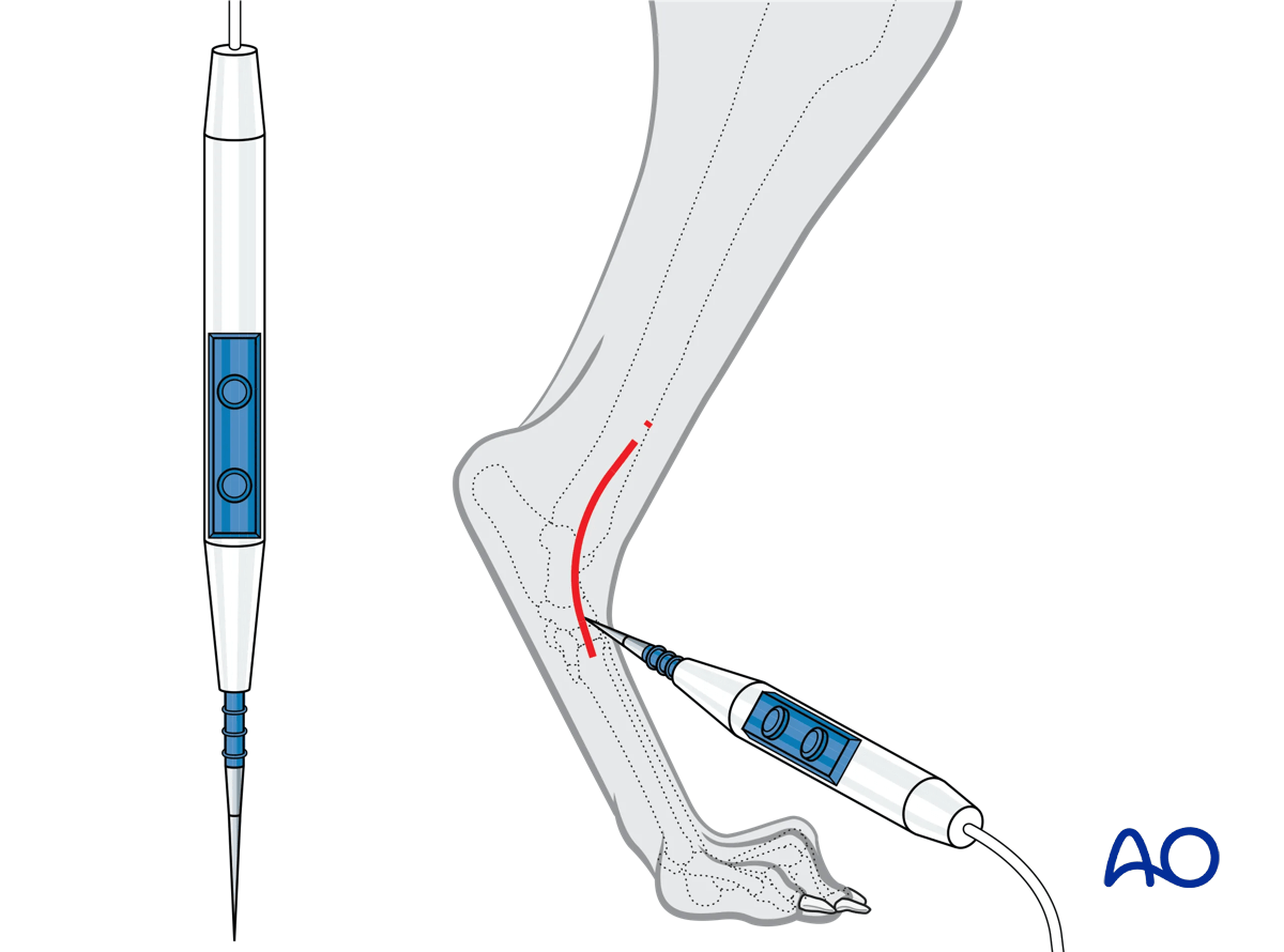 Medial approach to the dog distal tibia