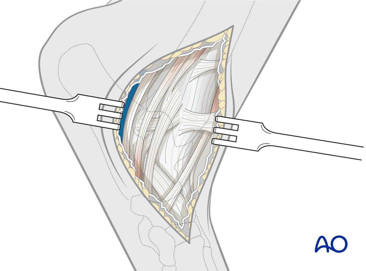 Medial approach to the dog distal tibia