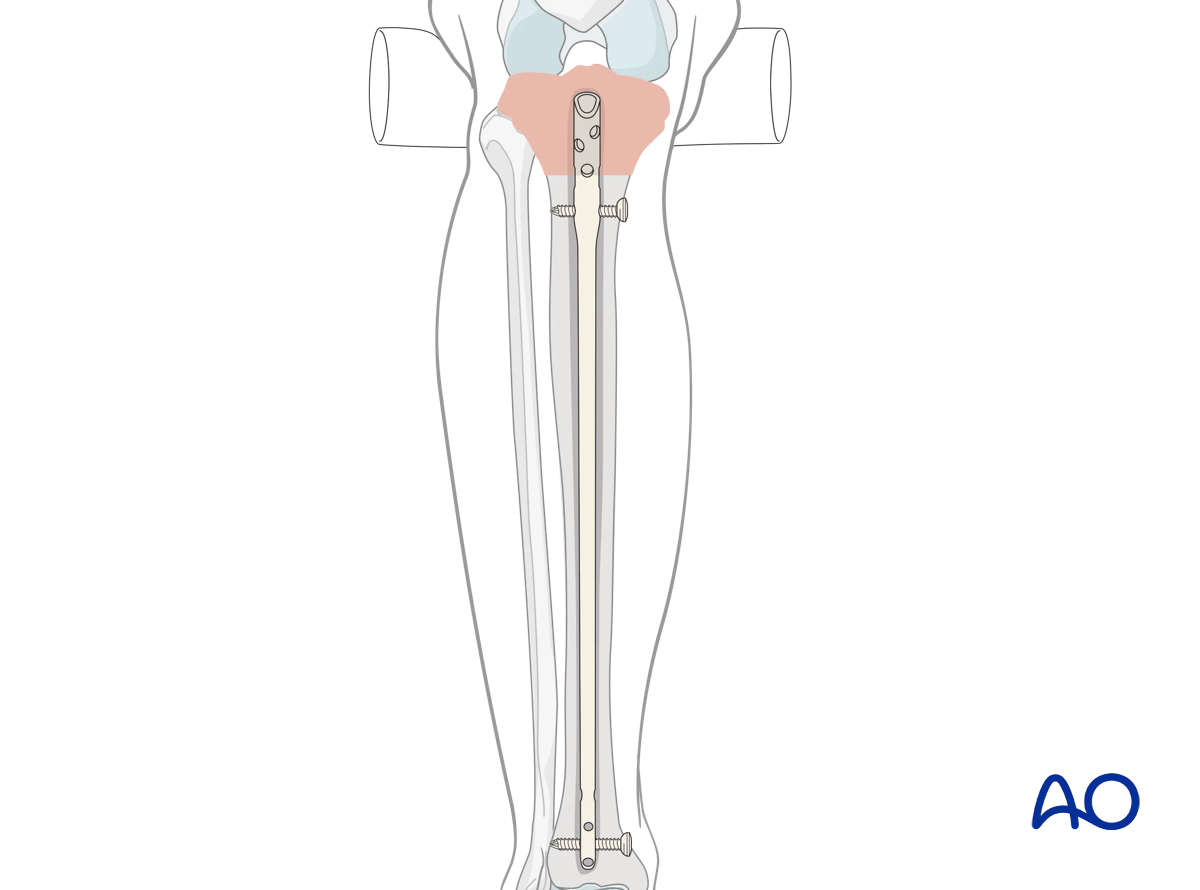 Suprapatellar intramedullary nailing for Wedge or multifragmentary ...