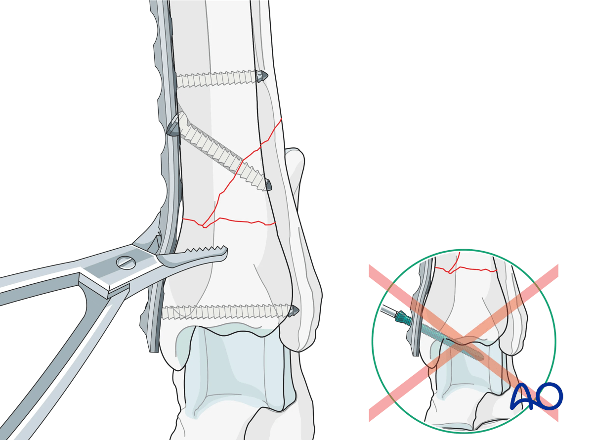 Neutralization plating (plate and lag screw) for Extraarticular wedge ...