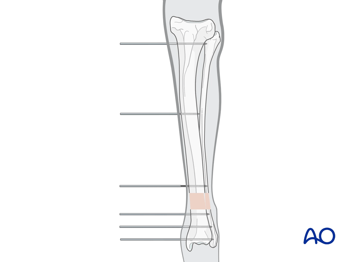 General considerations on external skeletal fixators