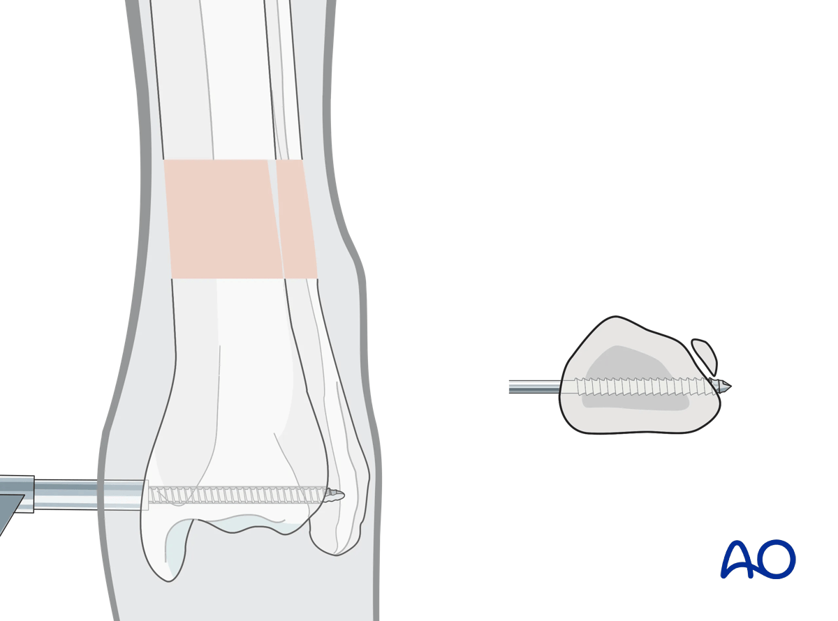 General considerations on external skeletal fixators