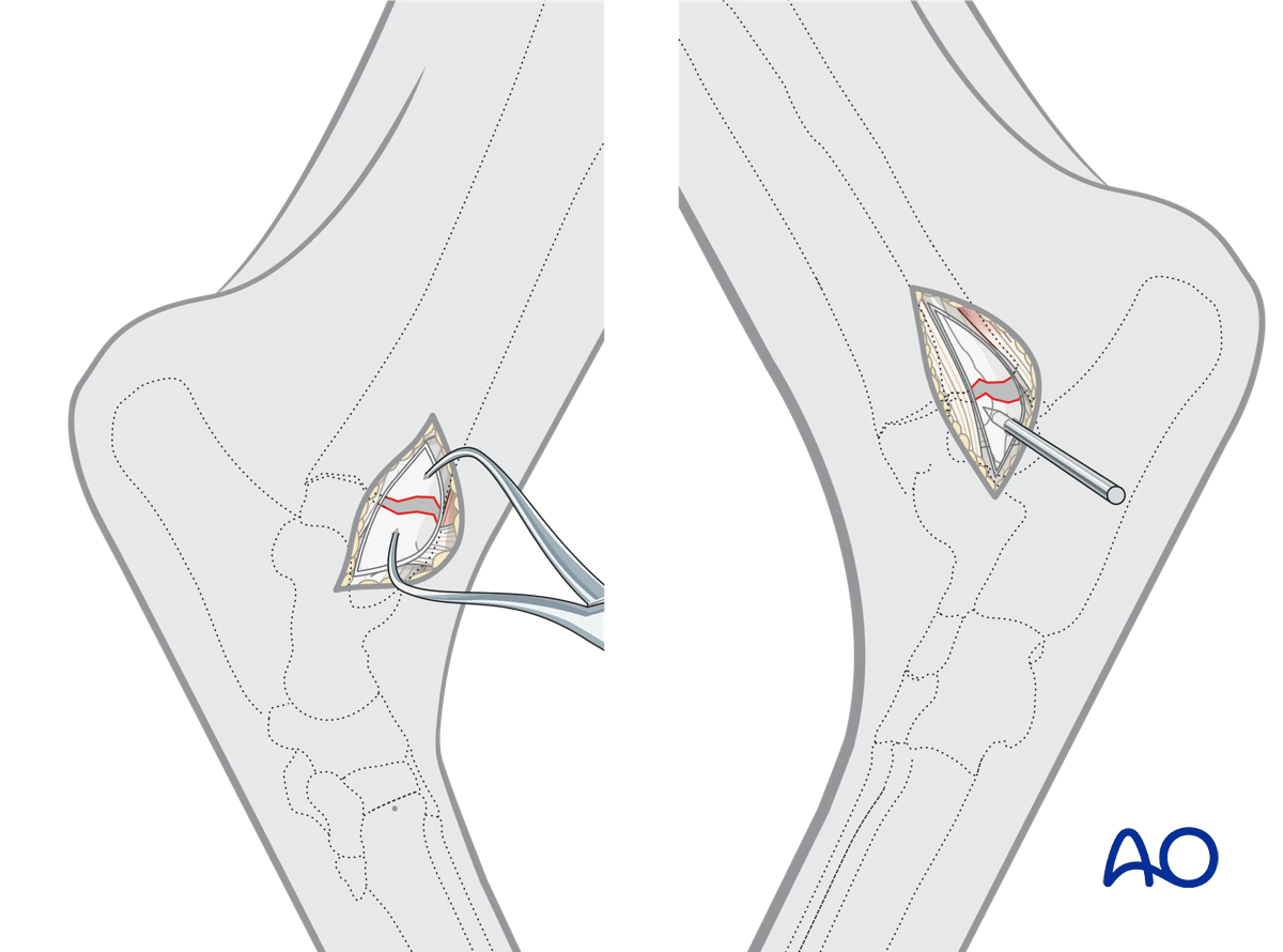 Minimally invasive approach to the dog distal tibia