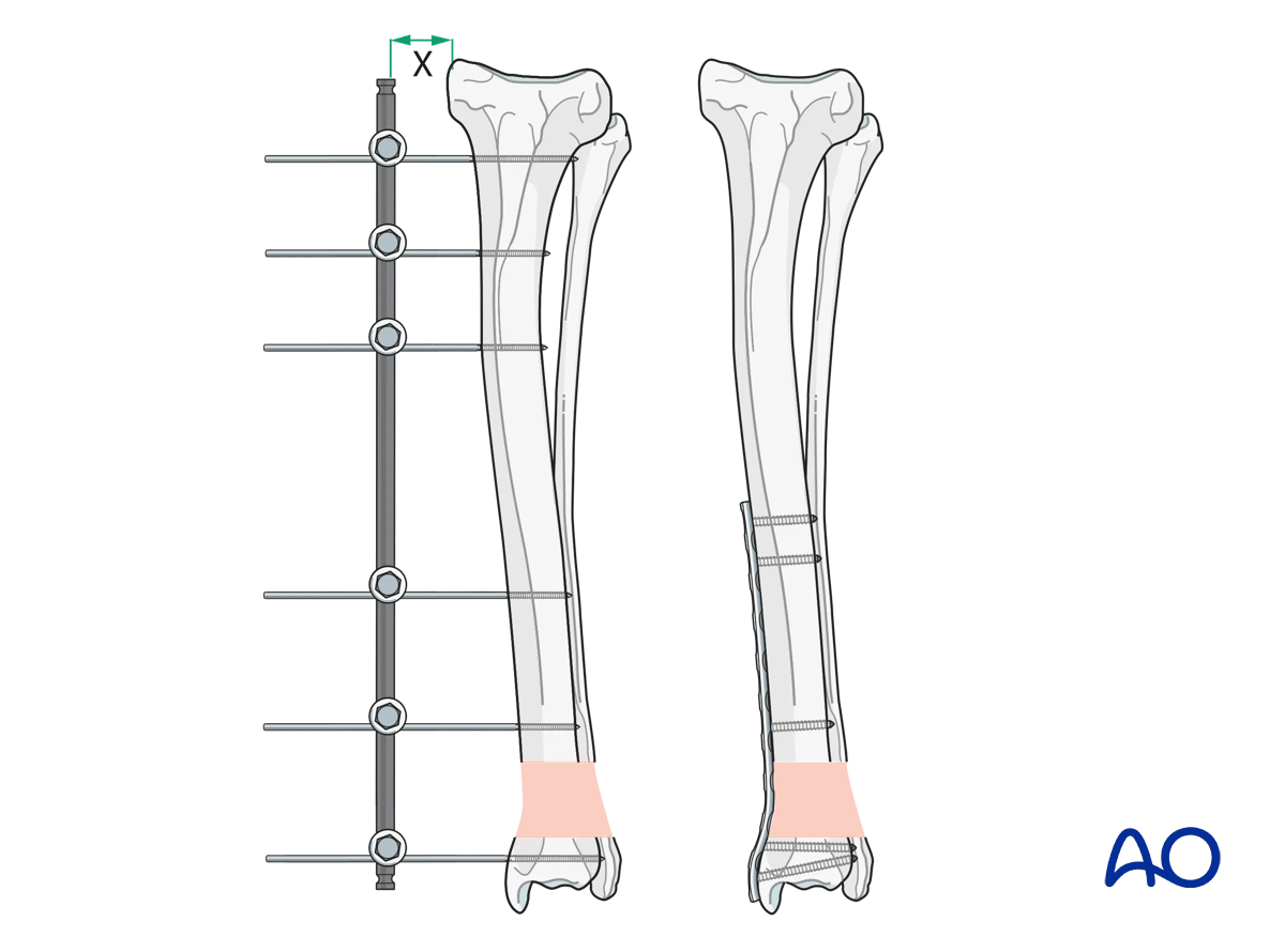 General considerations on external skeletal fixators