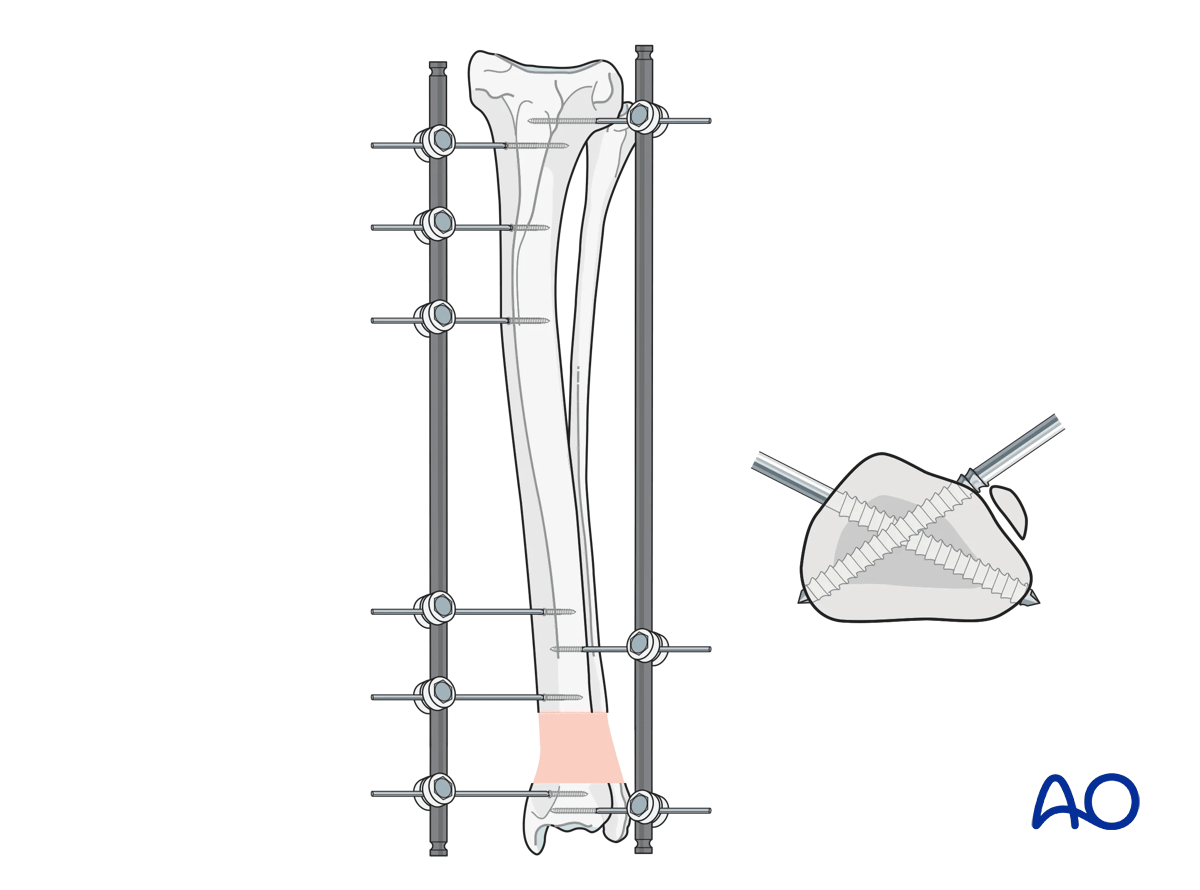 General considerations on external skeletal fixators
