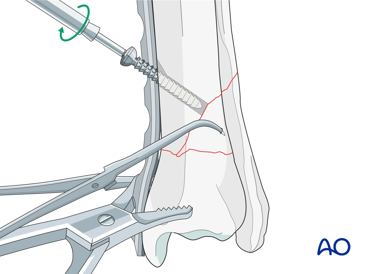 Neutralization plating (plate and lag screw) for Extraarticular wedge ...