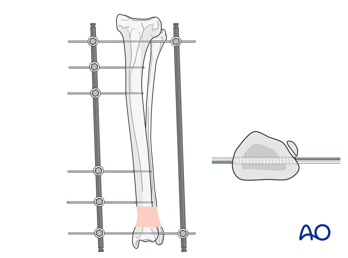 General considerations on external skeletal fixators