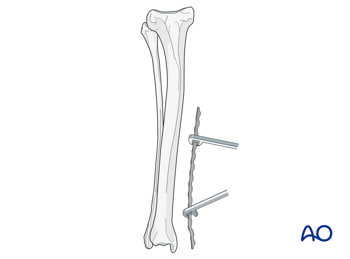 Neutralization plating (plate and lag screw) for Extraarticular wedge ...