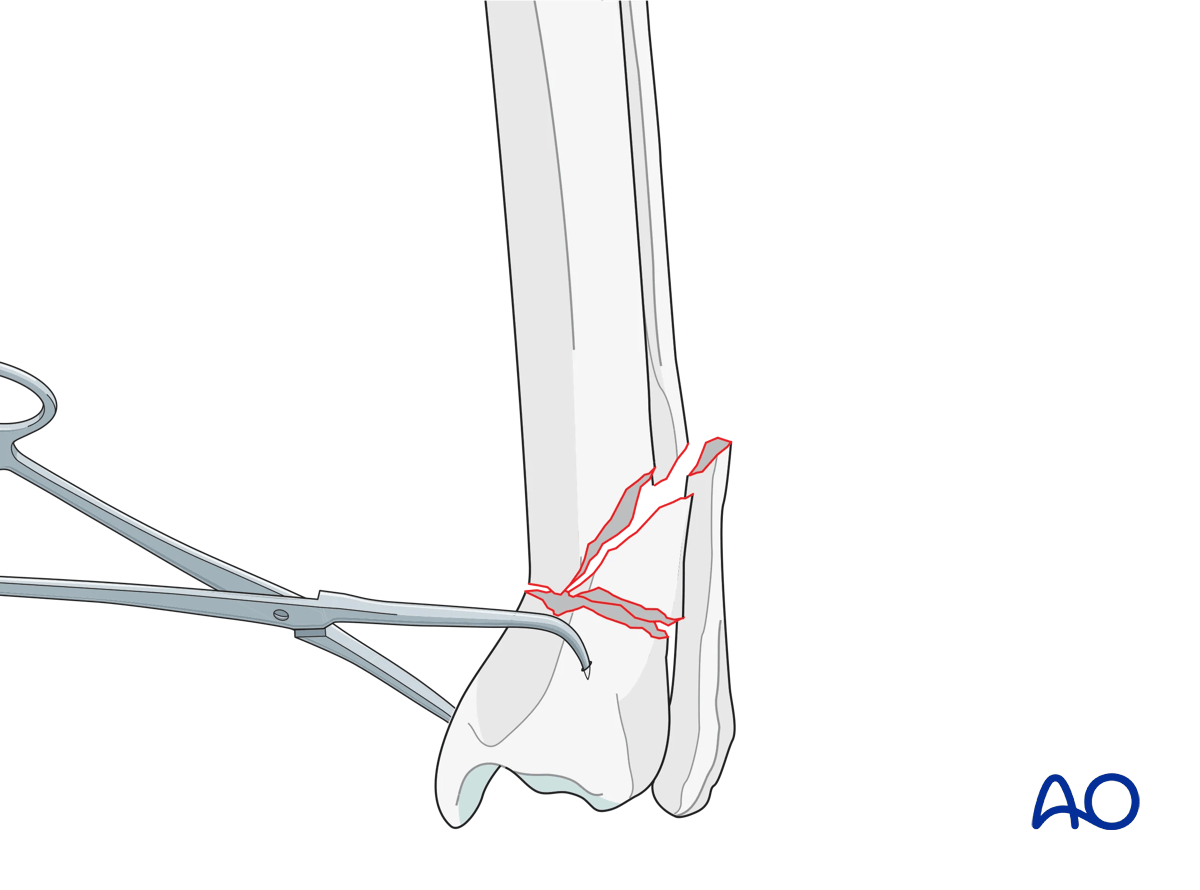 Neutralization plating (plate and lag screw) for Extraarticular wedge ...