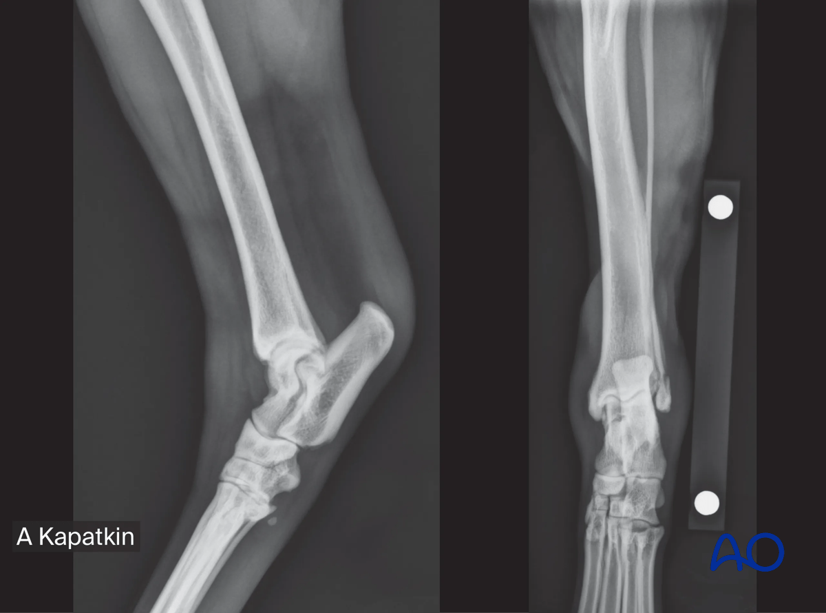 Screw fixation of the lateral malleolus for Partial articular lateral ...