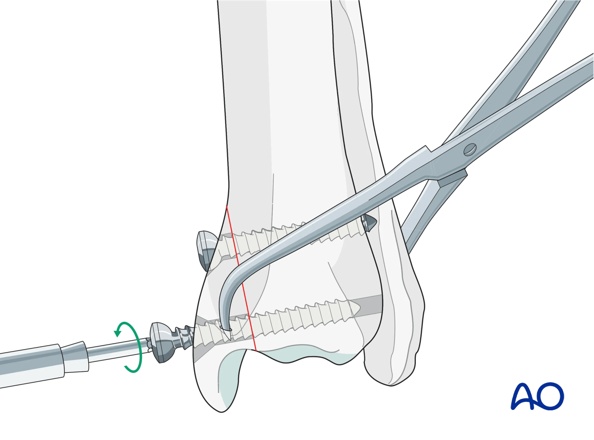 Lag screw fixation