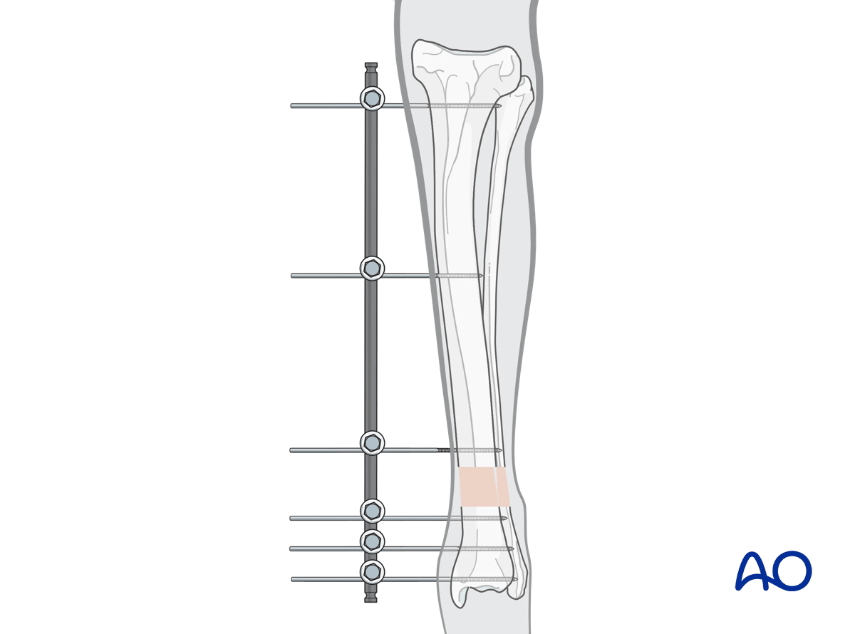 General considerations on external skeletal fixators