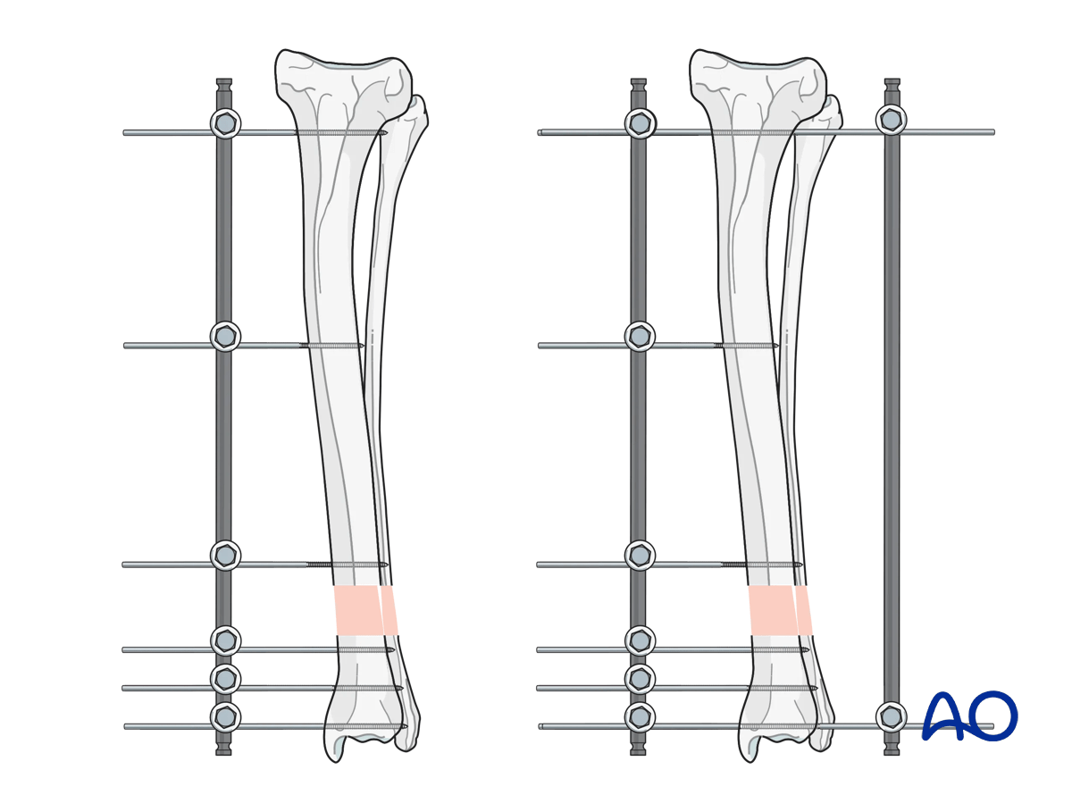 General considerations on external skeletal fixators