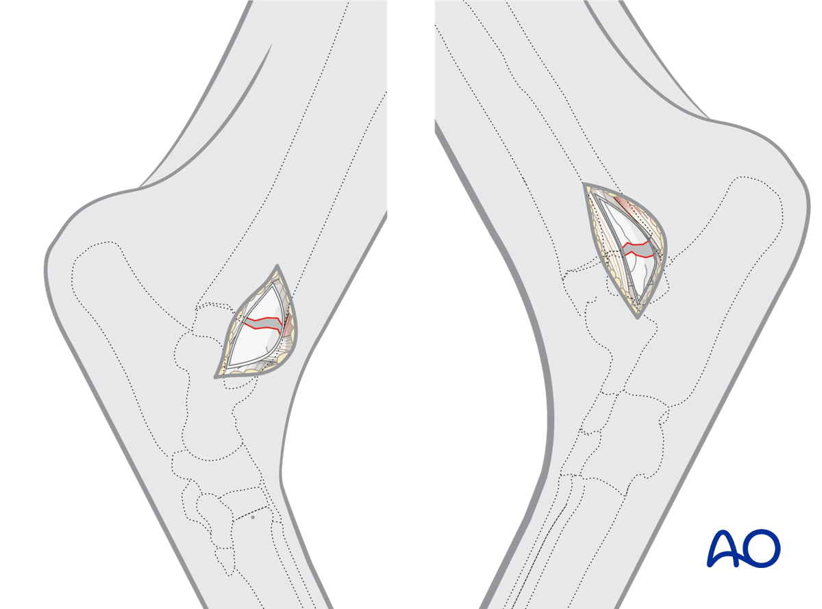 Minimally invasive approach to the dog distal tibia