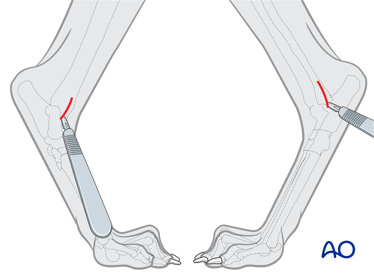 Minimally invasive approach to the dog distal tibia