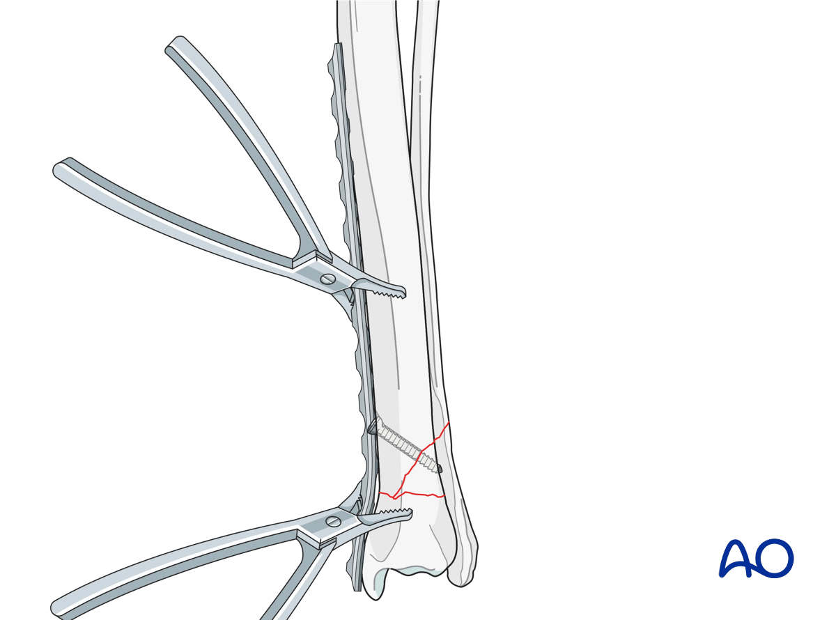 Neutralization plating (plate and lag screw) for Extraarticular wedge ...