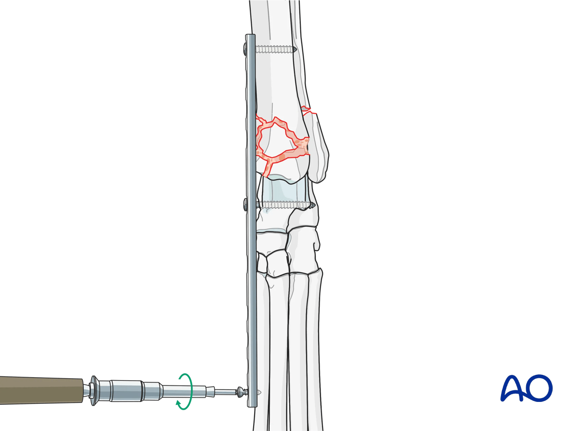 Plate fixation (pantarsal arthrodesis) for Simple articular ...